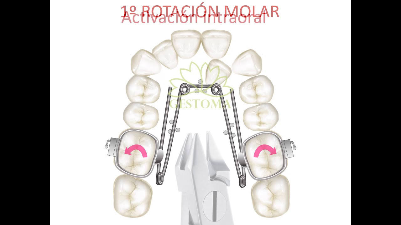 ¿Qué es el Aparato Ortodoncia Quad Helix? Funcionamiento y Beneficios ...