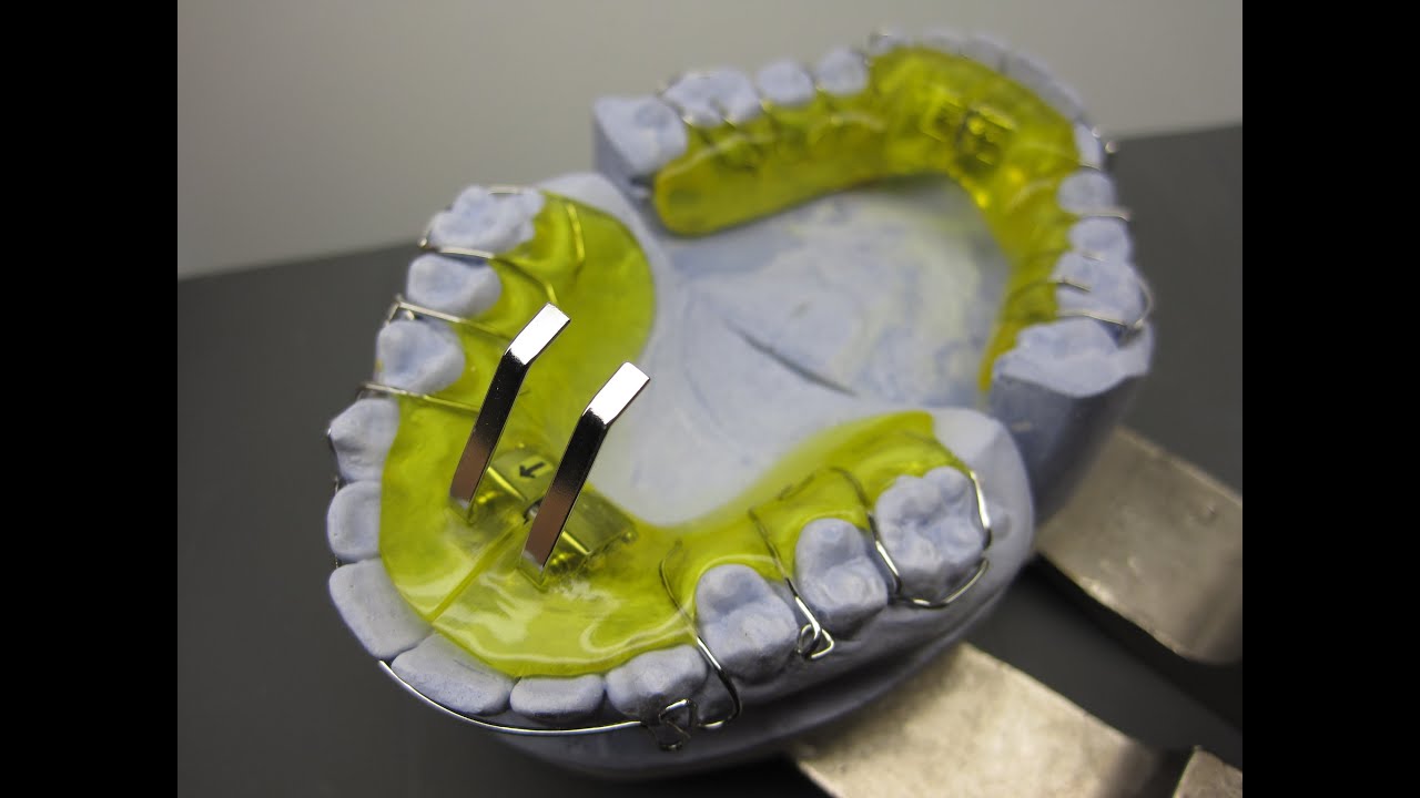 ¿Qué es el aparato Sanders en ortodoncia y para qué sirve? - ORTODONCIA ...