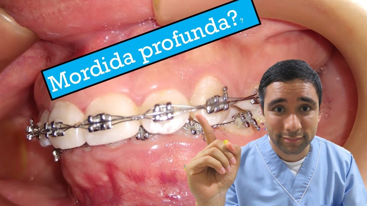 ¿Qué es el Arco de Curva Inversa en Ortodoncia? Beneficios y ...