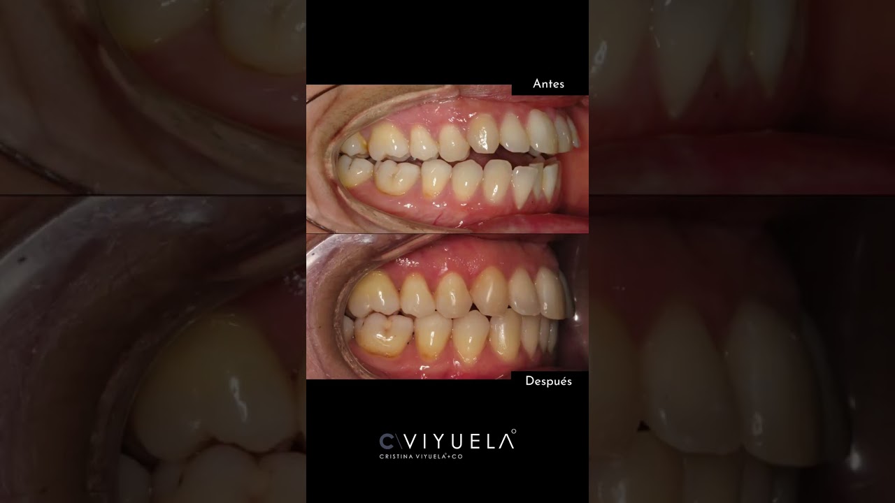 ¿Cuál es el papel de la cuca escribano en la ortodoncia? Conoce los ...