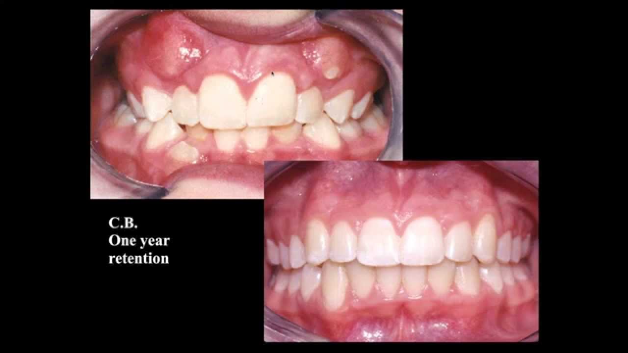 ¿Qué es un D'Gainer en Ortodoncia? Beneficios y Resultados del ...