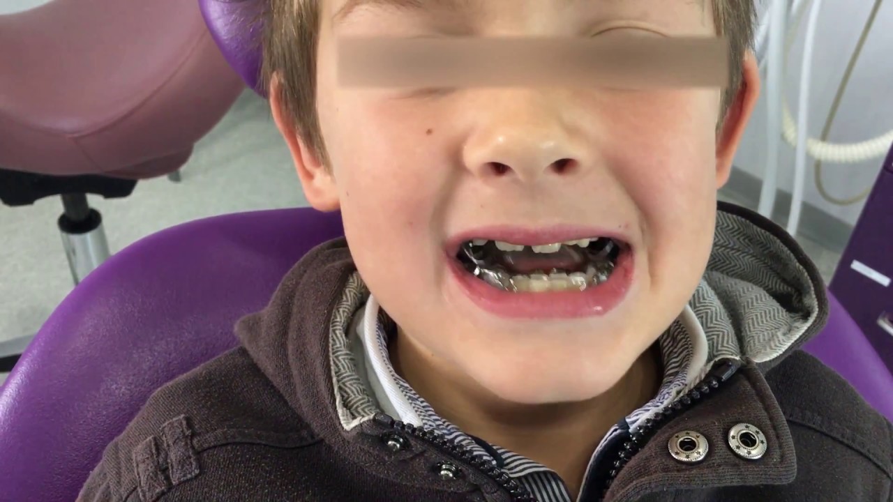 ¿Qué es el Dispositivo Calvin Case en Ortodoncia? Beneficios y ...