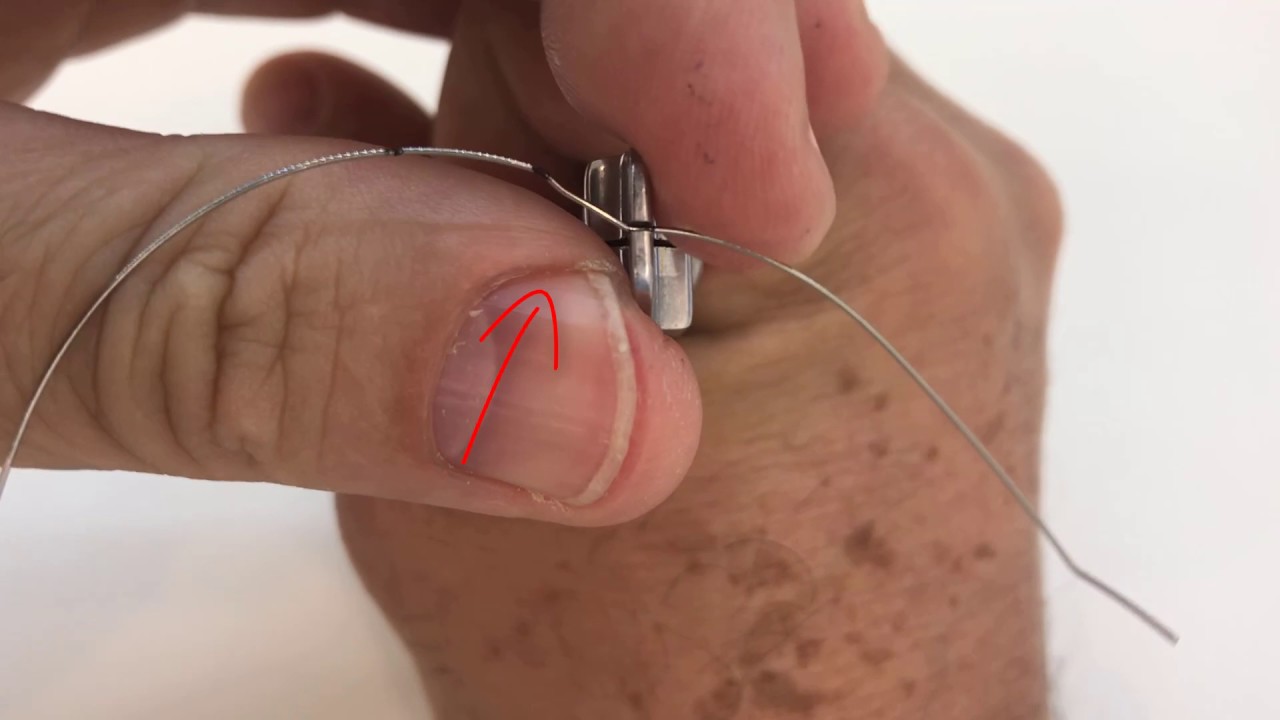 ¿Qué es el Inset Offset en Ortodoncia? Todo lo que Debes Saber sobre ...