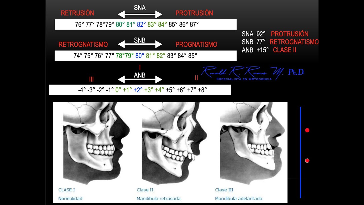 ¿Qué es el Jarabak en Ortodoncia? Concepto y Aplicaciones en el ...