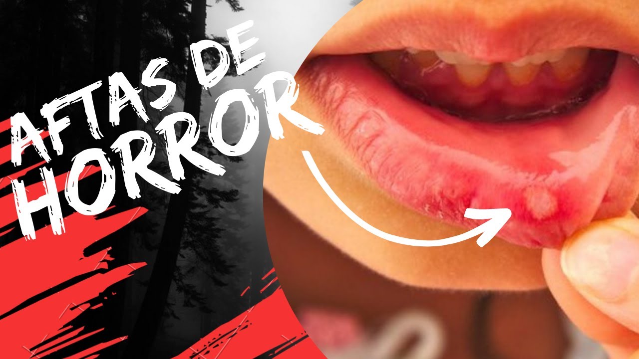 ¿Por qué aparecen llagas bucales con la ortodoncia? Causas y soluciones para un tratamiento ...