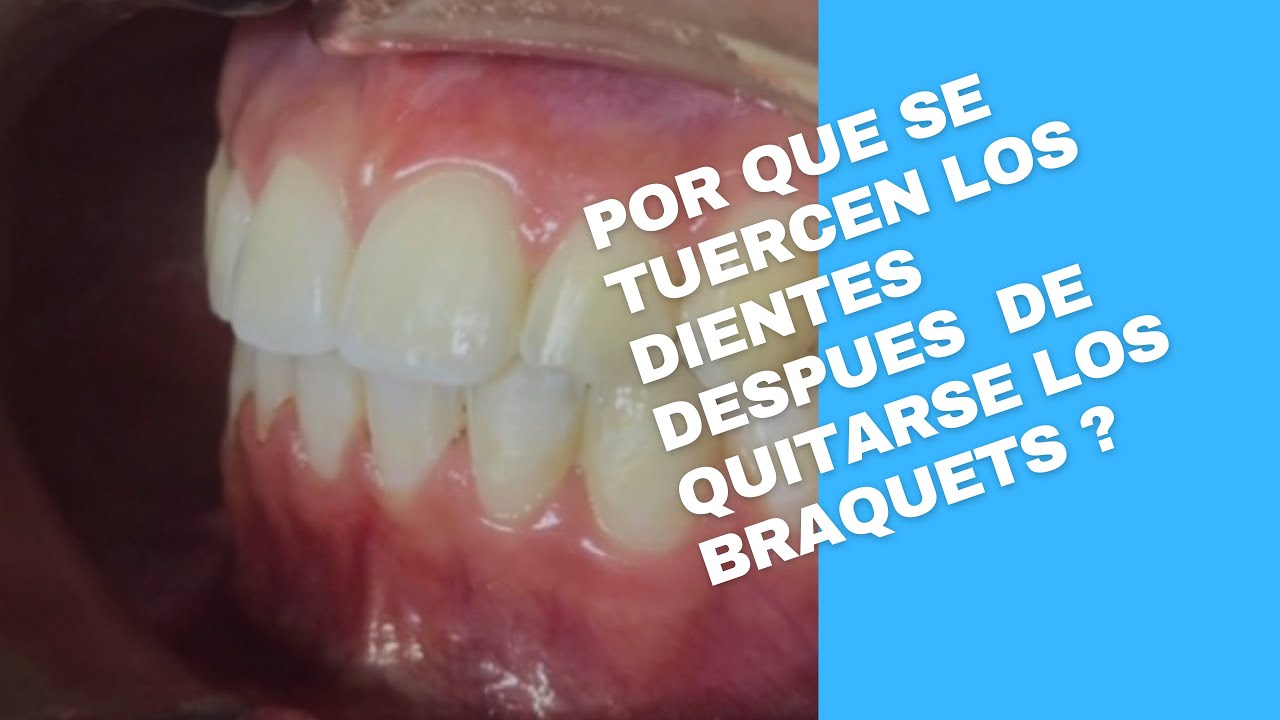 ¿Por qué los dientes pueden torcerse después de la ortodoncia? Causas y ...