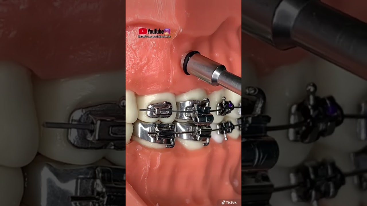 Mini Tornillo 1,6 mm x 6 mm para un Mejor Alineamiento Dental ...