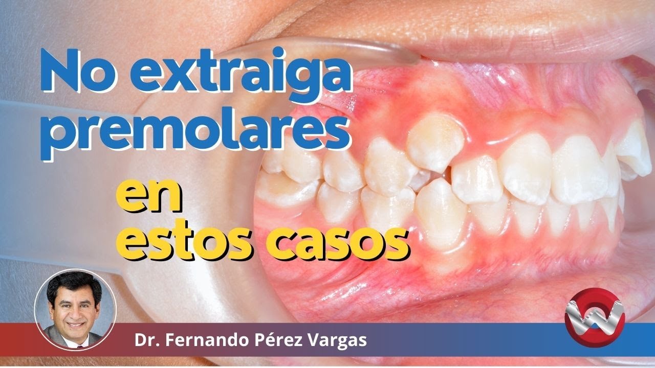 ¿Qué es Moaw en Ortodoncia? Todo lo que Necesitas Saber sobre la ...