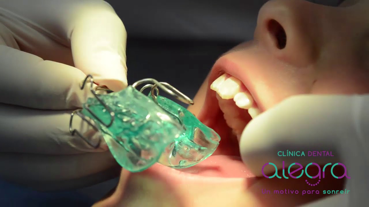 ¿Cuándo es recomendable el uso de un paladar en la corrección de la ...