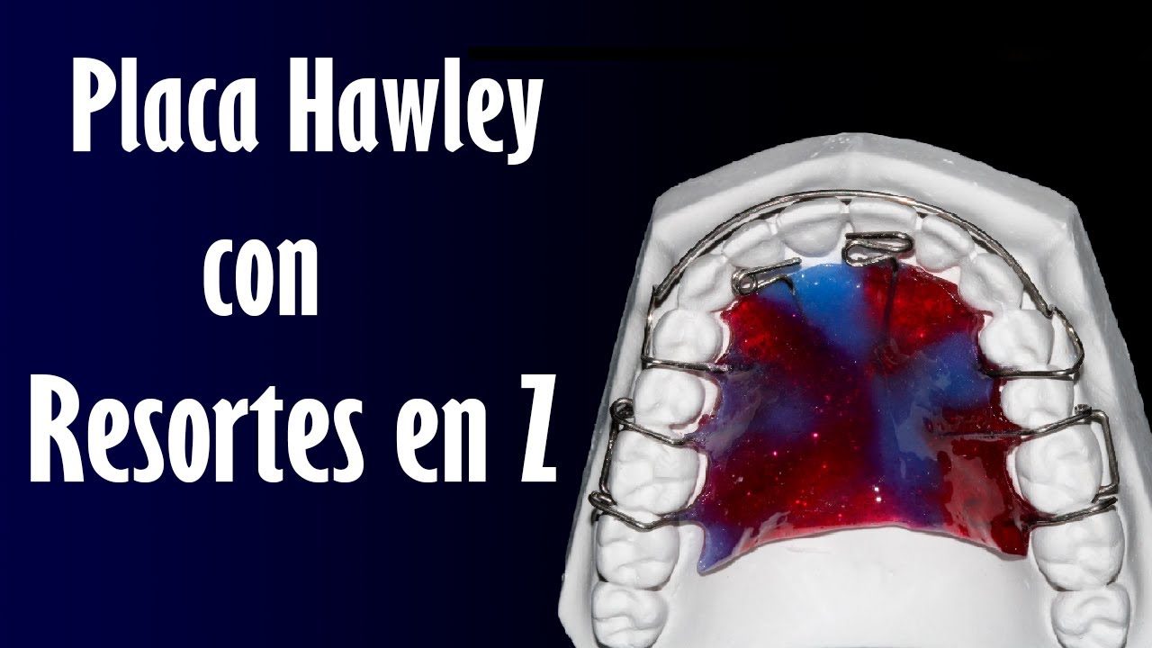 ¿Qué es un resorte en Z en ortodoncia? Funcionamiento y beneficios para ...