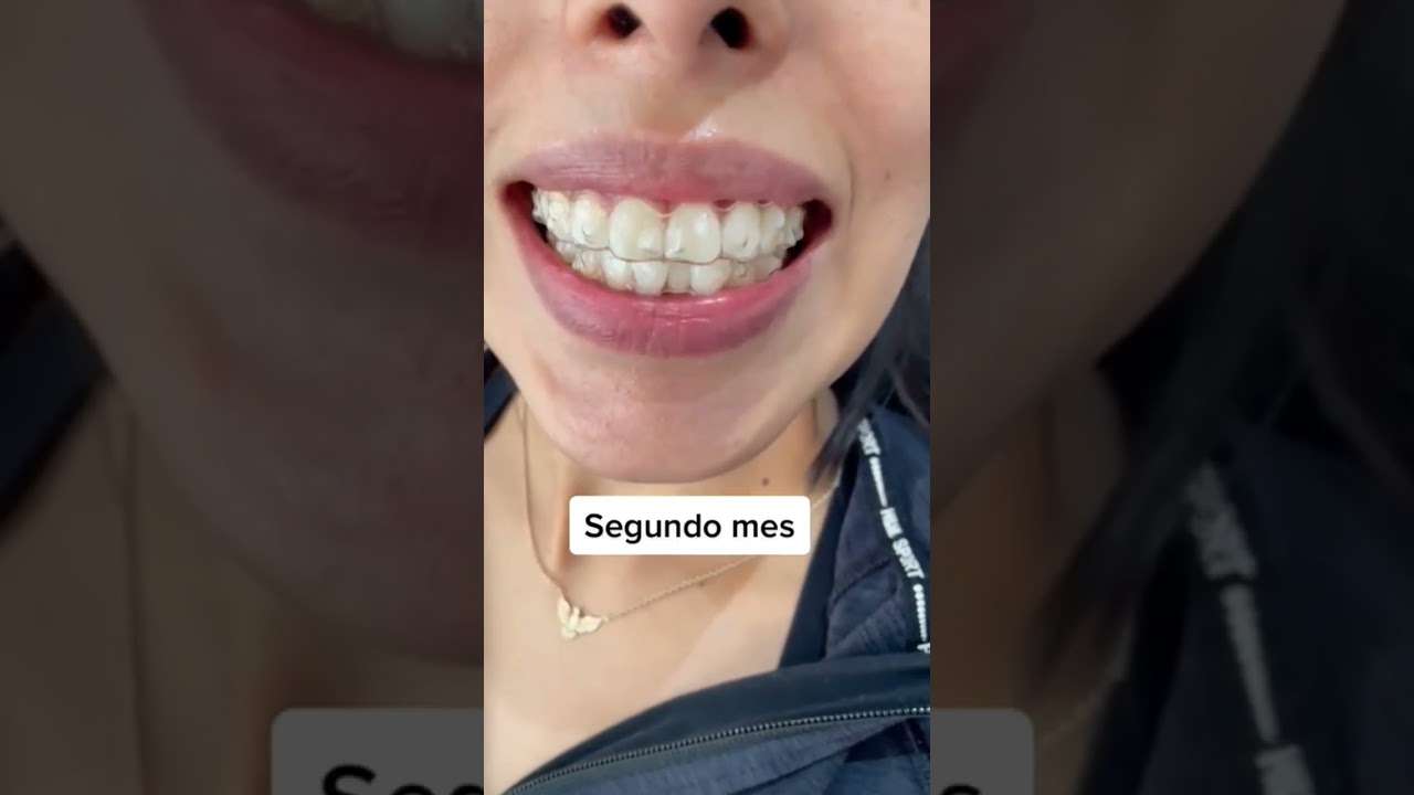¿Es la opción Diamond 2 Apex la mejor elección para tu sonrisa ...